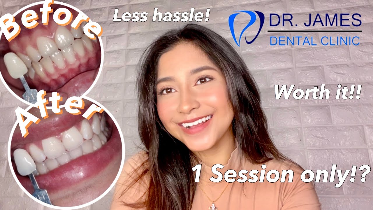 MY FIRST TEETH WHITENING EXPERIENCE!! SUPER EFFECTIVE FOR 1 SESSION ...