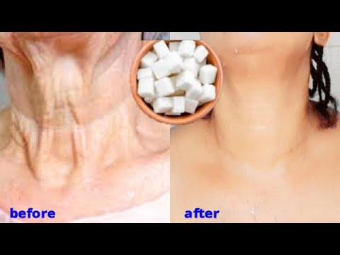Use sugar in 5 min remove neck wrinkles fast get rid of neck lines - YouTube