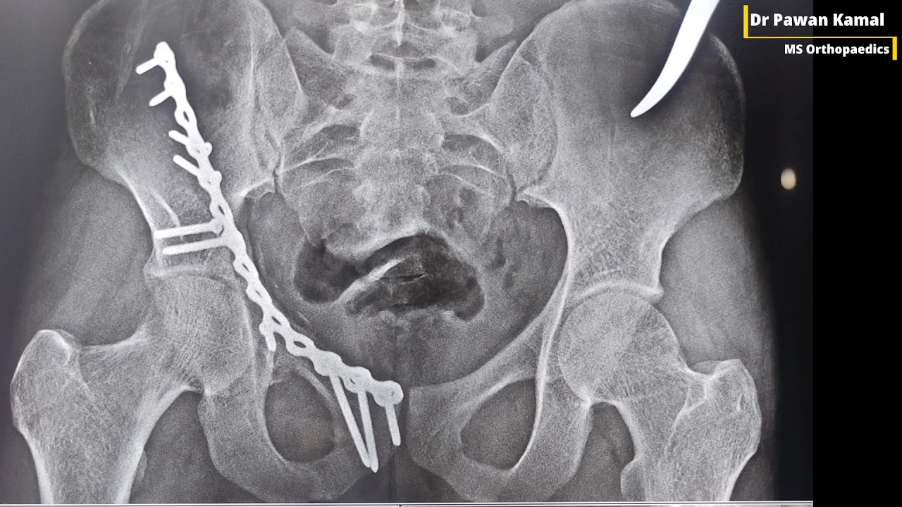 Acetabulum fracture results - YouTube
