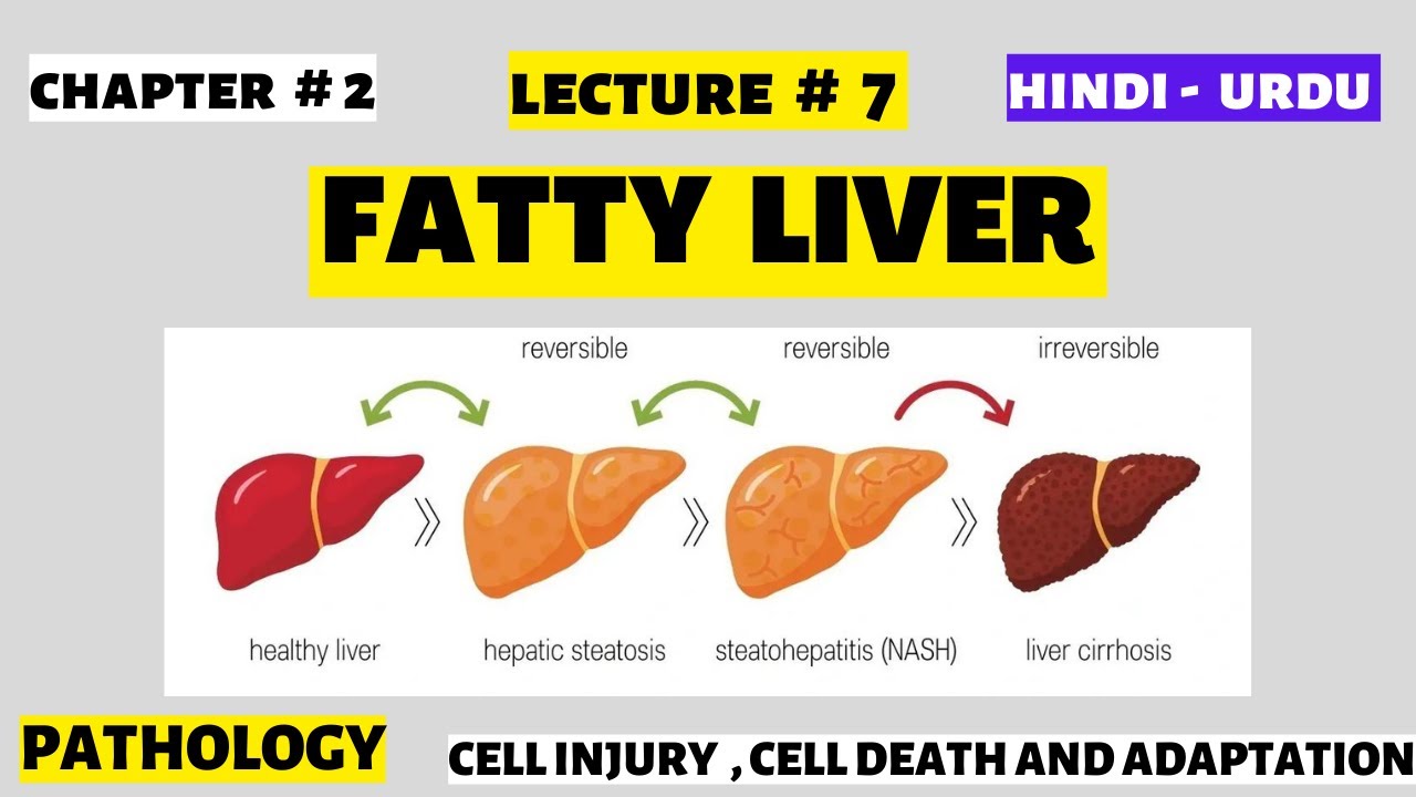 Fatty Change ( Steatosis ) || Fatty Liver || Cell Injury , Cell Death ...