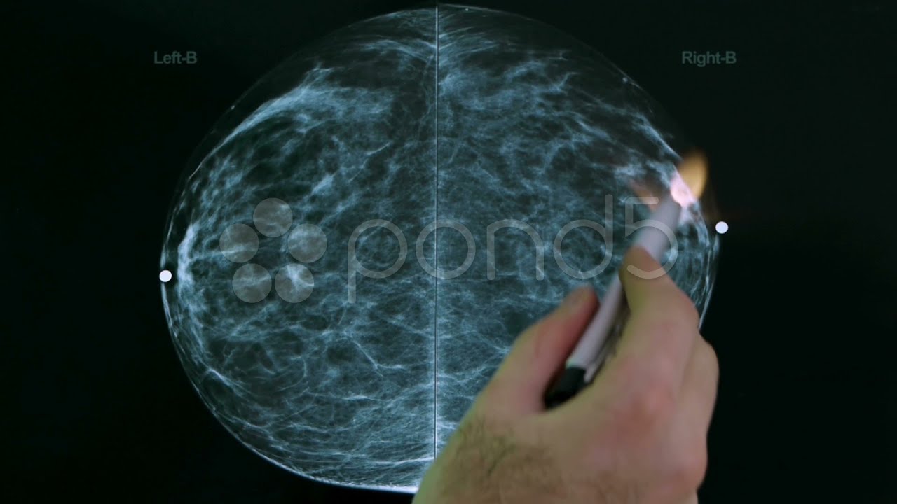 Mammogram X Ray Analysis (Hd). Stock Footage - YouTube