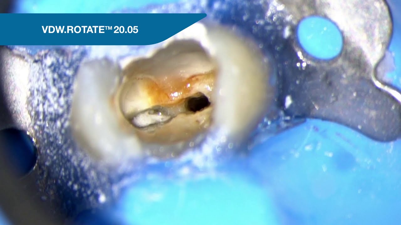 VDW Dental · VDW.ROTATE: Preparation by Dr. Nuno Pinto (clinical video ...