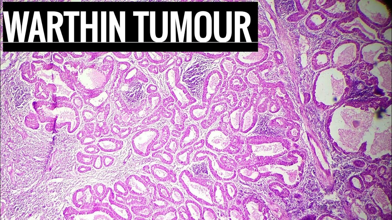 Warthin Tumour Histopathology - YouTube
