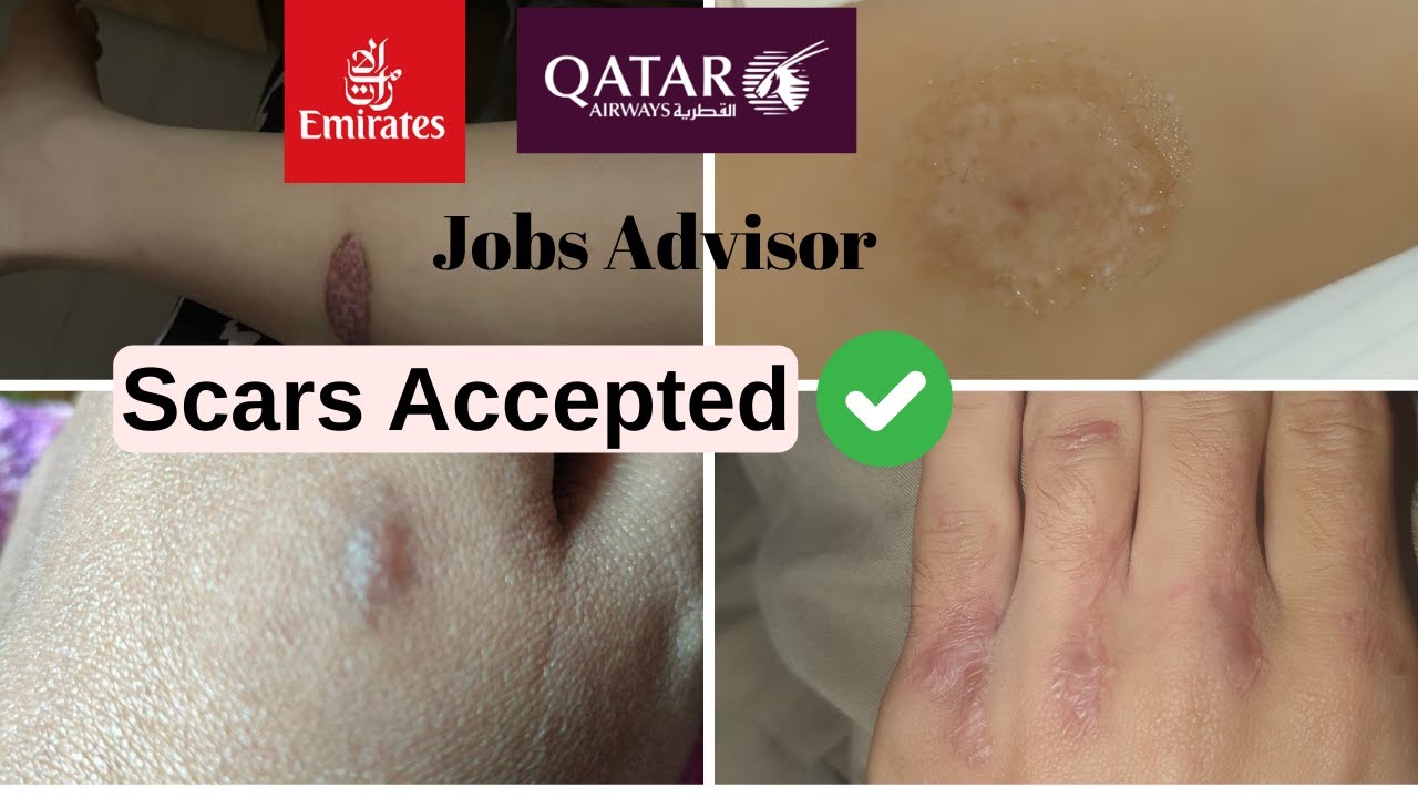 Scars Accepted? Emirates Cabin Crew Requirements Explained! - YouTube