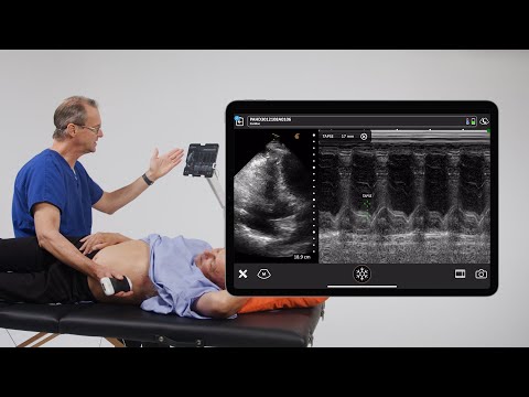 What Is Tapse In Echocardiography