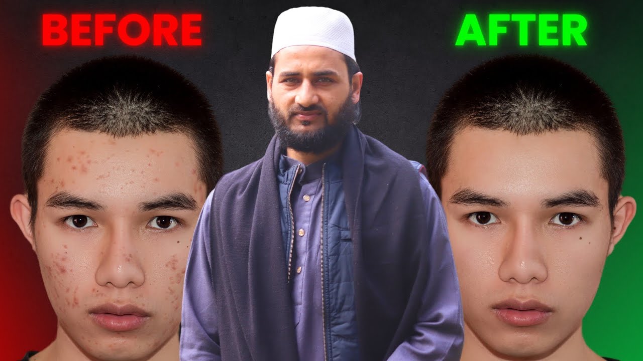 [Pimples, Acne, Marks, Muhase] Chehere Ke Daagh Dhabbe Hatane Ki Dua ...