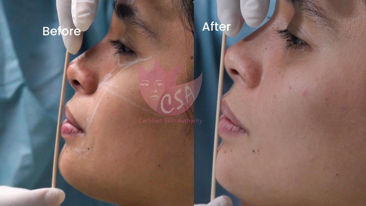 TRIANGLE OF YOUTH: CHEEKS AND CHIN FILLER - YouTube