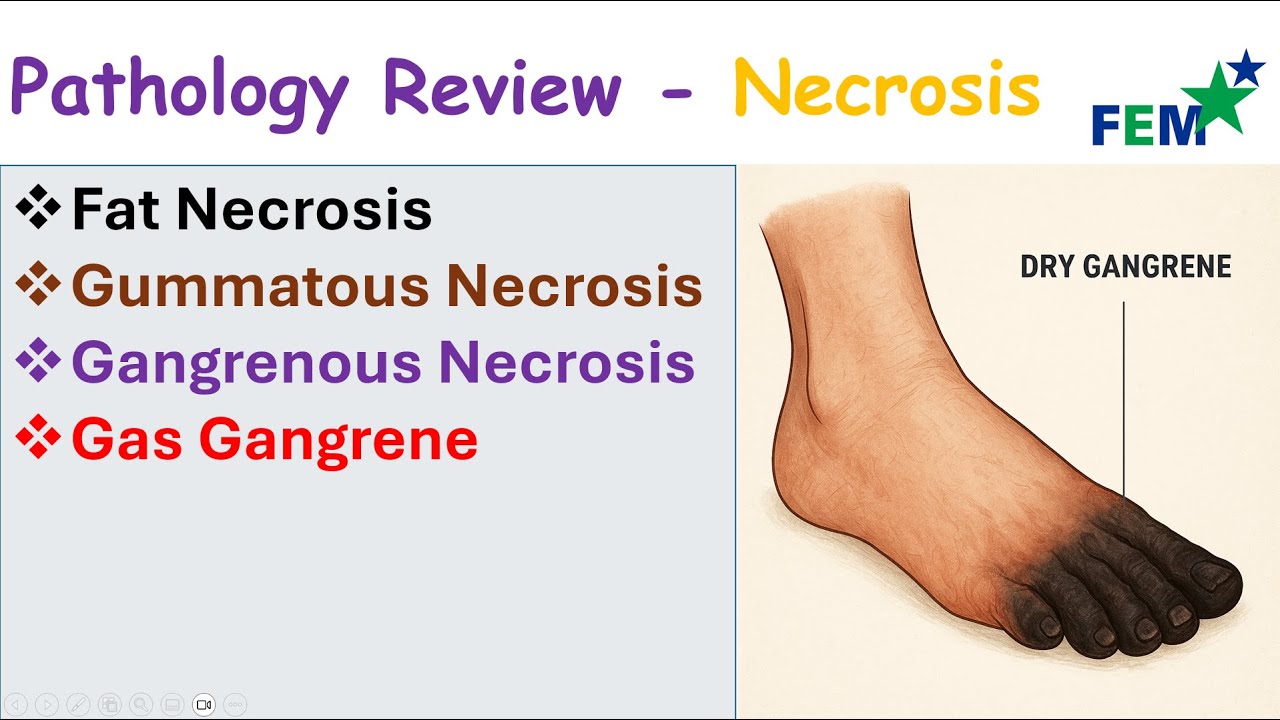 📘 Fat Necrosis, Gummatous Necrosis & Gangrenous Necrosis | Pathology ...