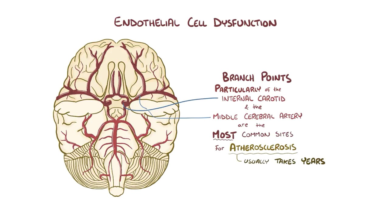 Ischemic Stroke Causes Symptoms Diagnosis Treatment Pathology YouTube ischemic-stroke-causes-symptoms-diagnosis-treatment-pathology-youtube