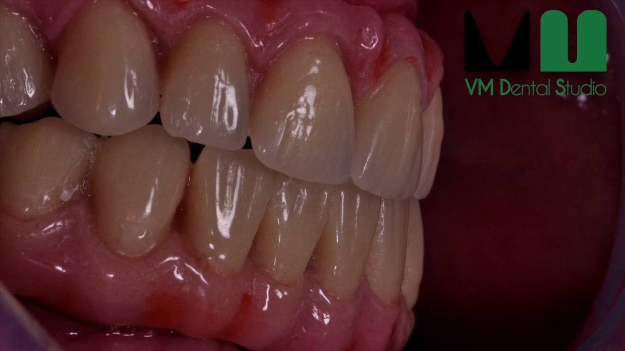 Protesis Híbridas sobre 6 Implantes Superior e Inferior - YouTube