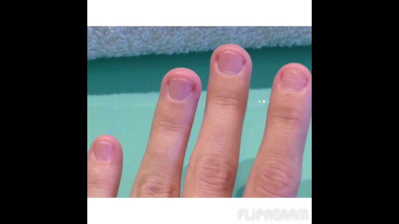 My Nail Biting Journey before After Pics 2 YouTube My Nail Biting Journey before After Pics 2 YouTube