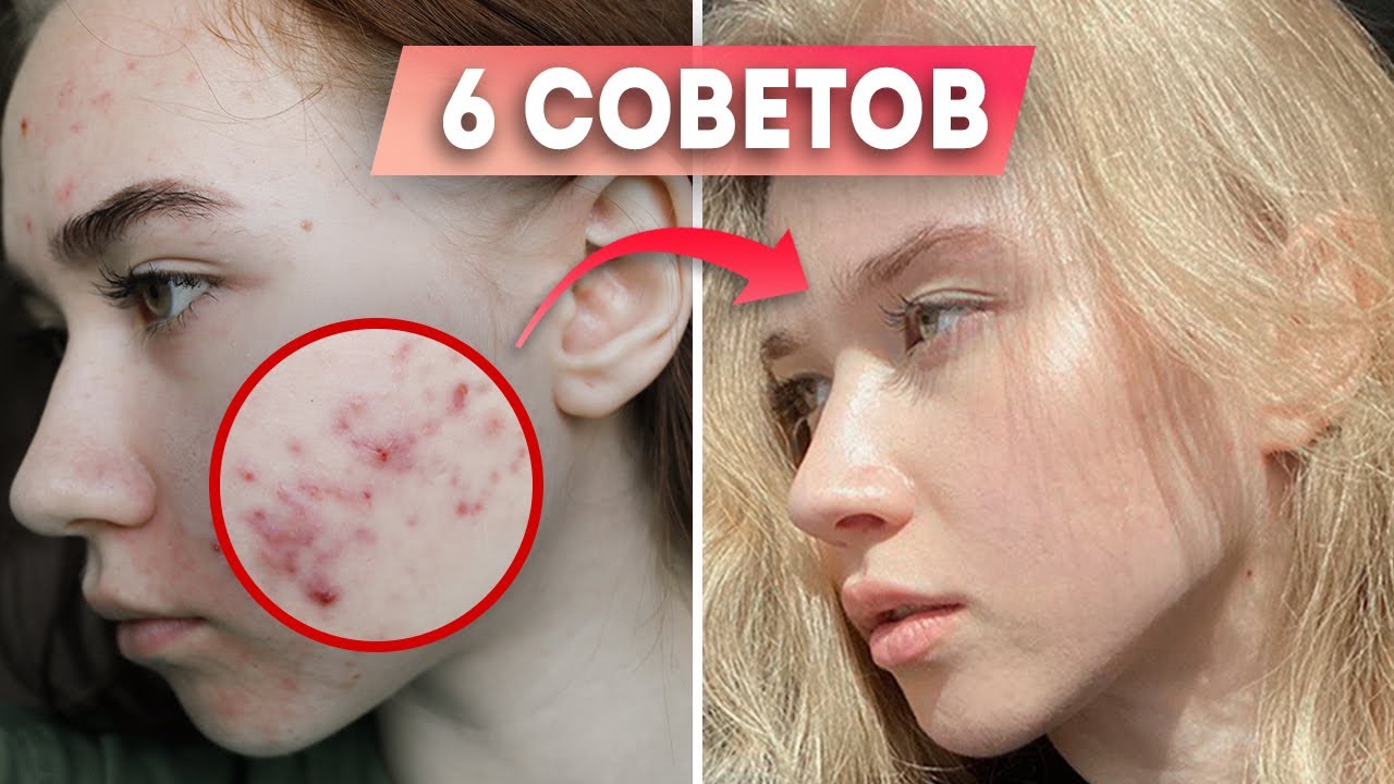 6 советов как избавиться от прыщей мой путь к чистой коже Как