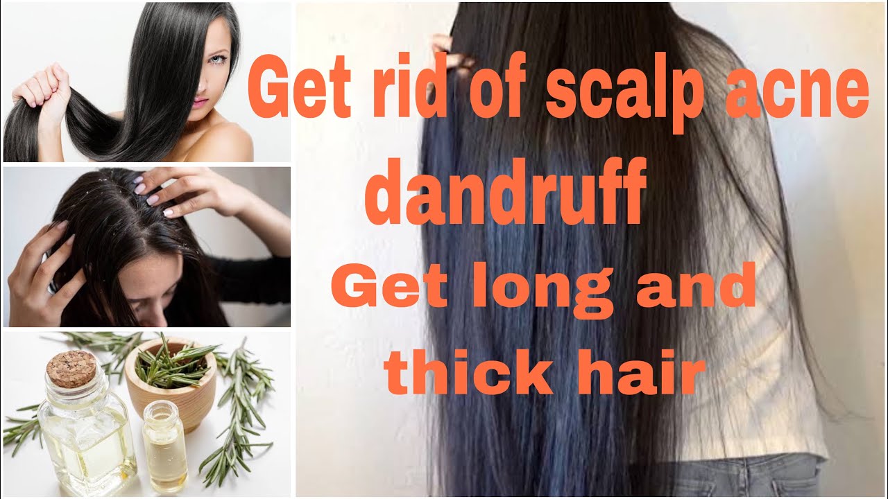 How to Stop Hair Fall and Dandruff Naturally/Grow Hair Faster/Regrow ...