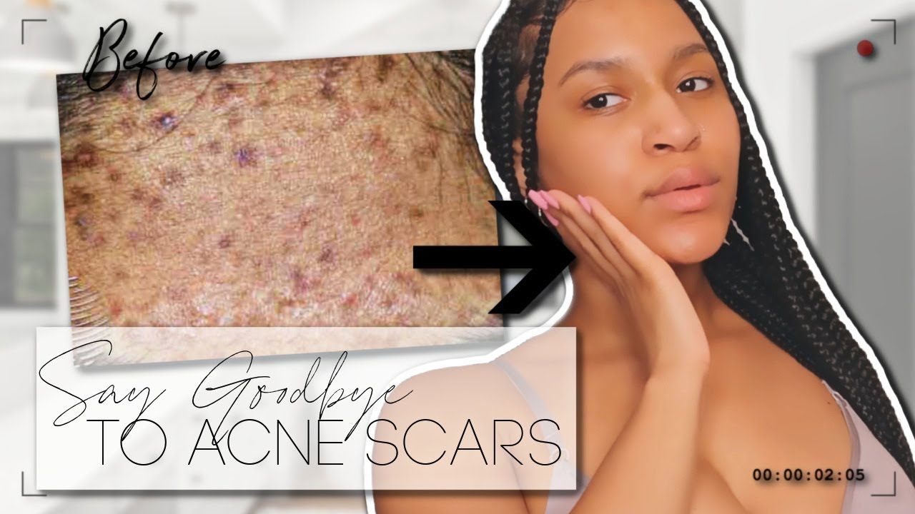 GET RID OF DARK SPOTS ON FACE IN 3 DAYS MUST WATCH YouTube get-rid-of-dark-spots-on-face-in-3-days-must-watch-youtube