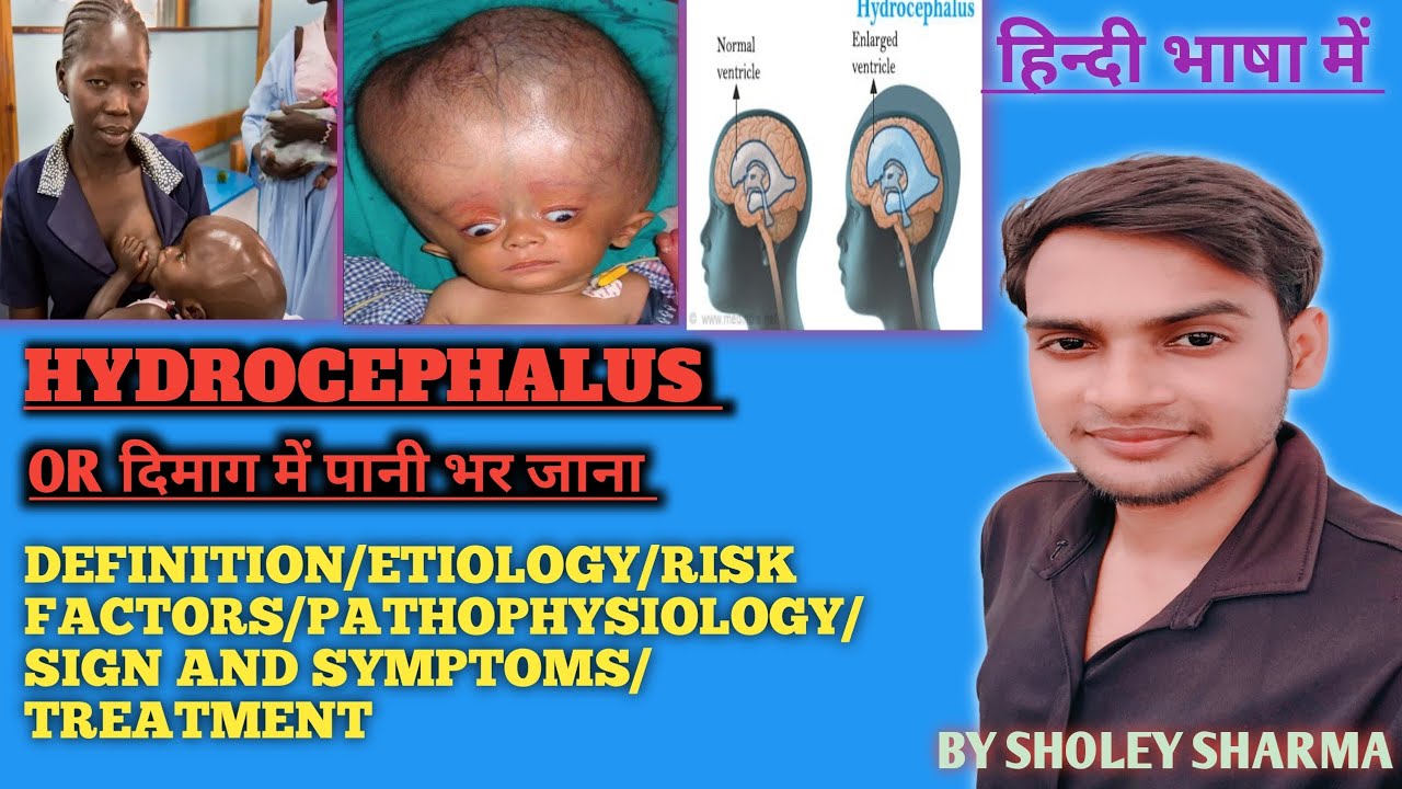 Hydrocephalus || Causes || Signs and Symptoms ||Diagnosis and Treatment ...