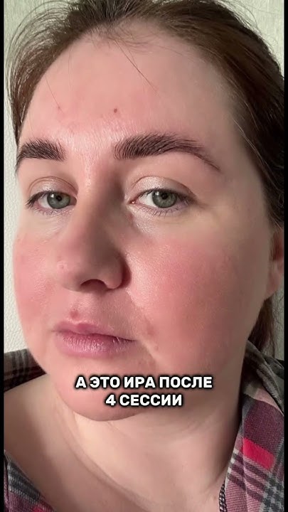 Как избавиться от высыпаний на лице? #психосоматика #розацеа #акне # ...