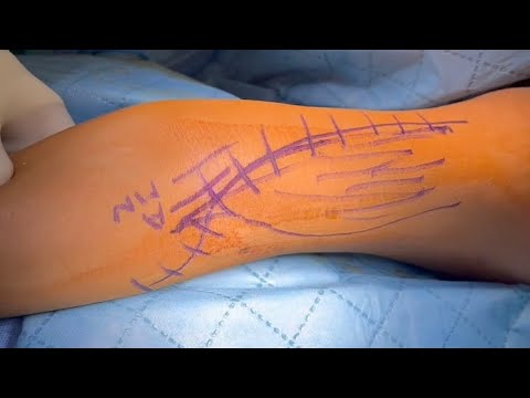 Surgical Techniques of Distal Humerus Resection and Endoprosthetic ...