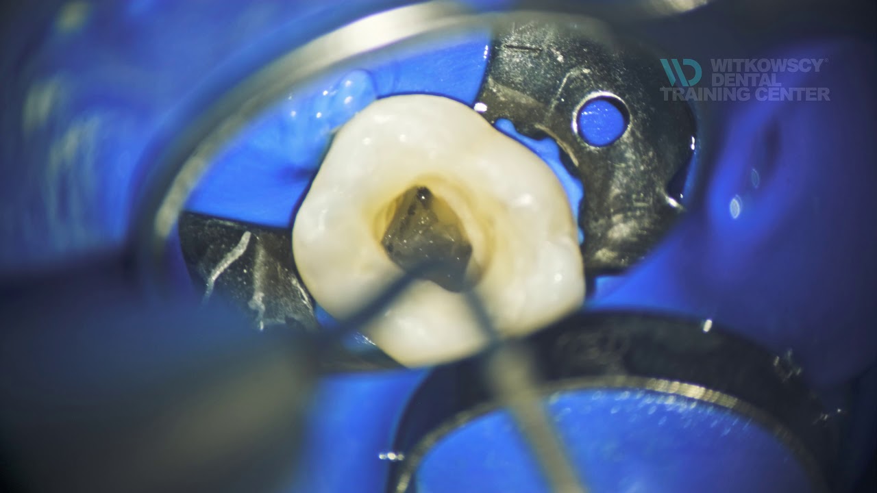 Pulp Stone removal with ultrasonics - YouTube