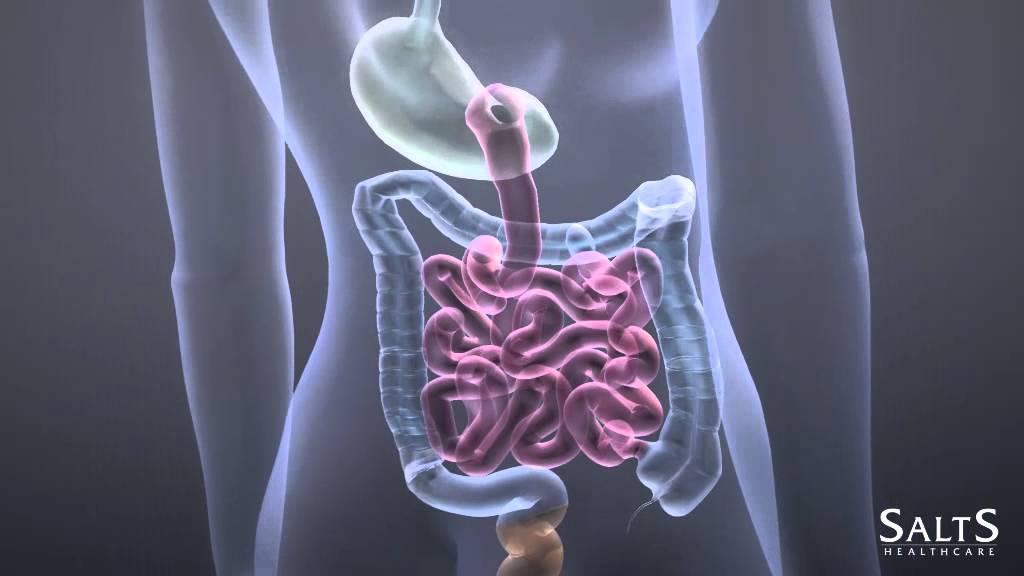 Kolostomi – inför operation - YouTube