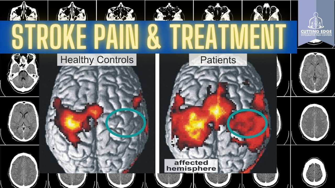 Post Stroke Chronic Pain Why it happens who it affects and How to treat ...