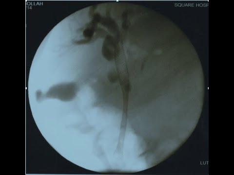 Cholangiocarcinoma ERCP Metallic Stent Deployment #BD_ENDOSCOPY - YouTube