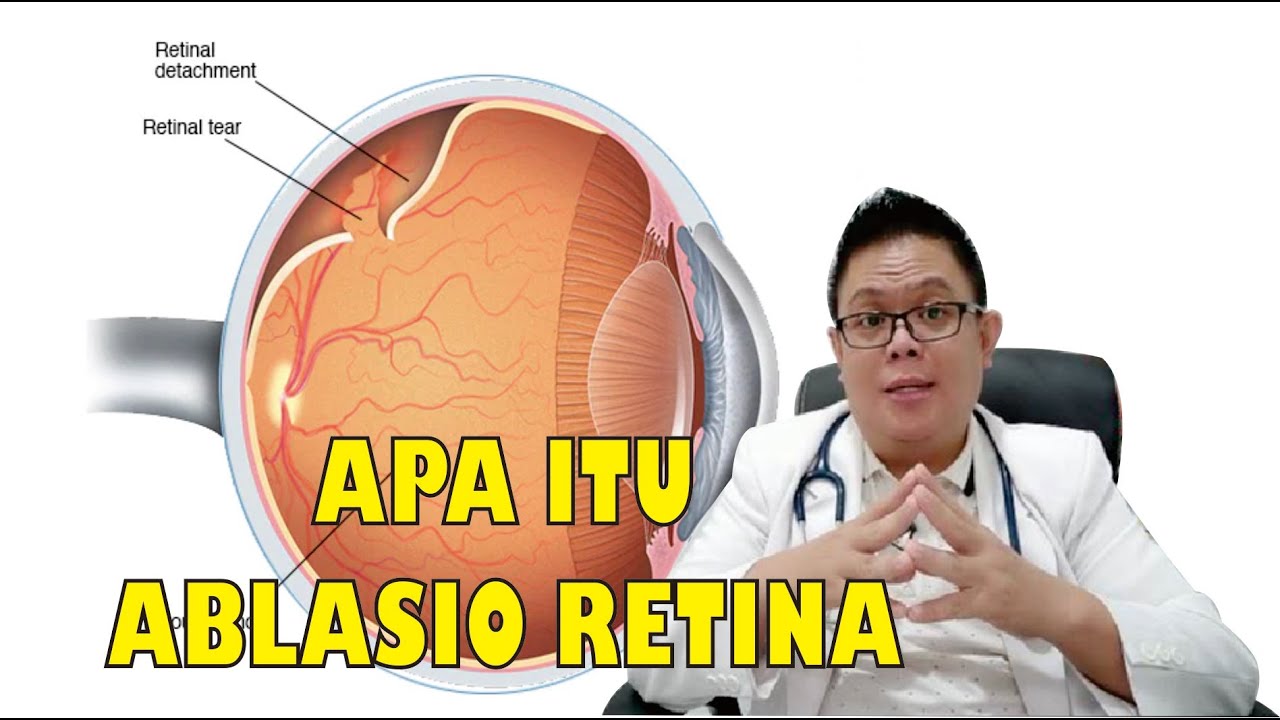 MENGENAL ABLASIO RETINA............ DEFINISI, PENYEBAB, GEJALA DAN ...
