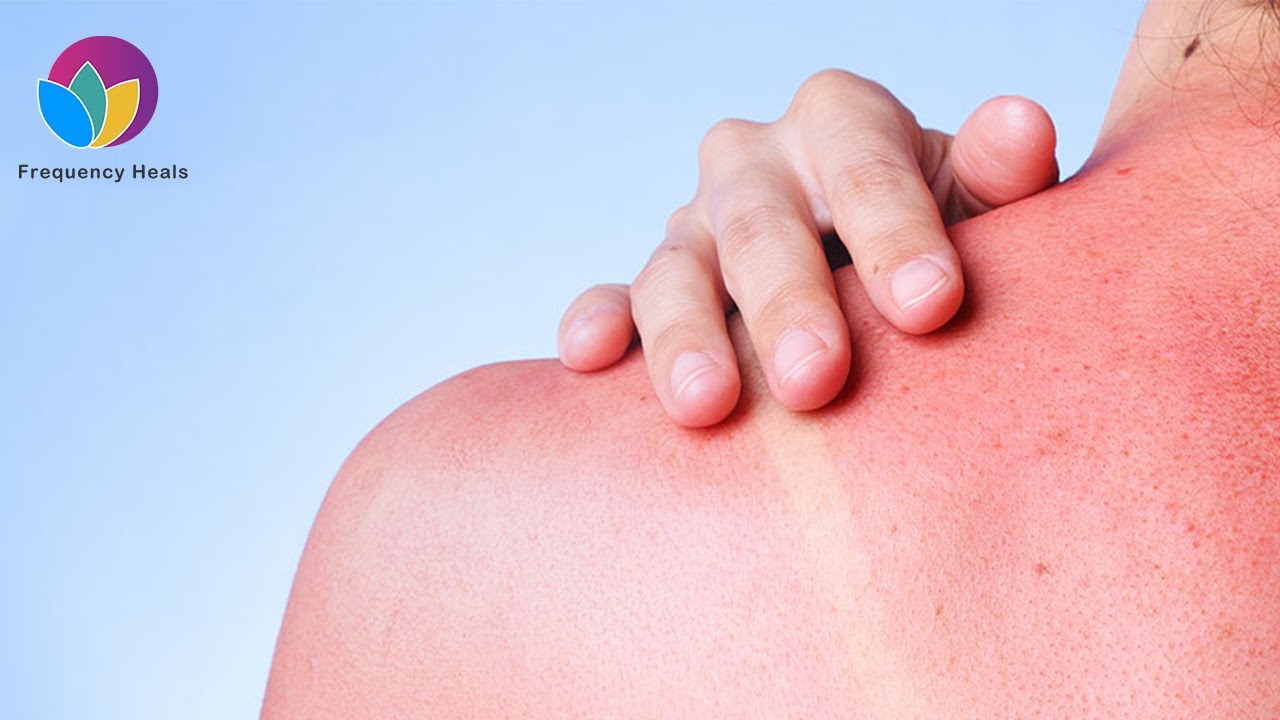 Sun Allergy Remedy | Remove Rashes and Hives & Relieve Allergic ...