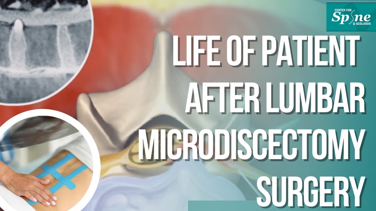Microdiscectomy Recovery