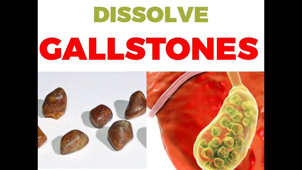 The FASTEST Way To Dissolve GALLSTONES ( The NO.1 Remedy + bonus ...