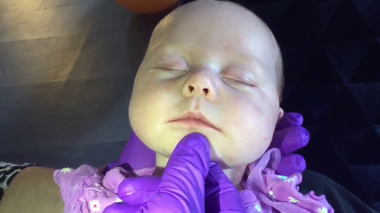 Sleeping Tongue Posture Hold - Pain Free Post Frenotomy Care - YouTube