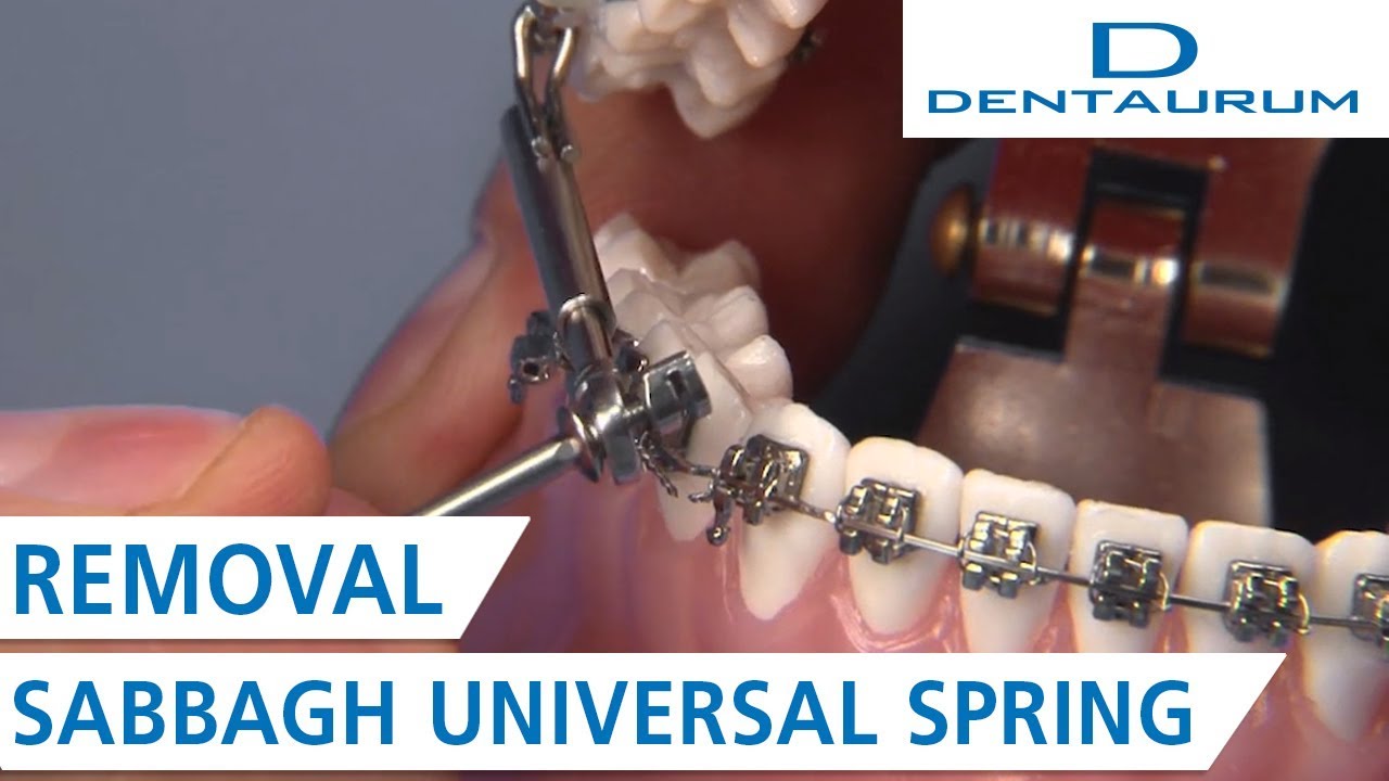 SUS removal - Sabbagh Universal Spring - YouTube