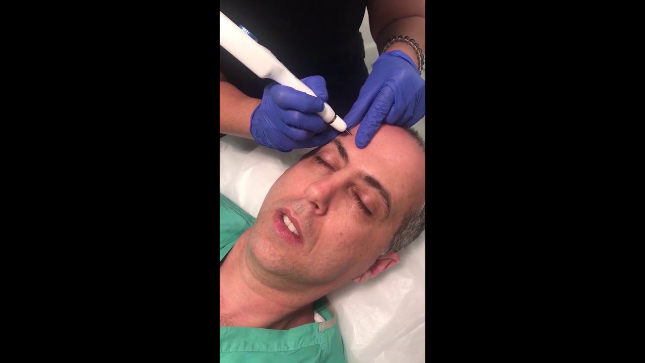 Amazing results with Fibroblast Plasma Pen after single treatment ...