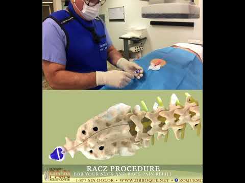 Racz procedure for LOW BACK PAIN RELIEF, 9-5-18 - YouTube