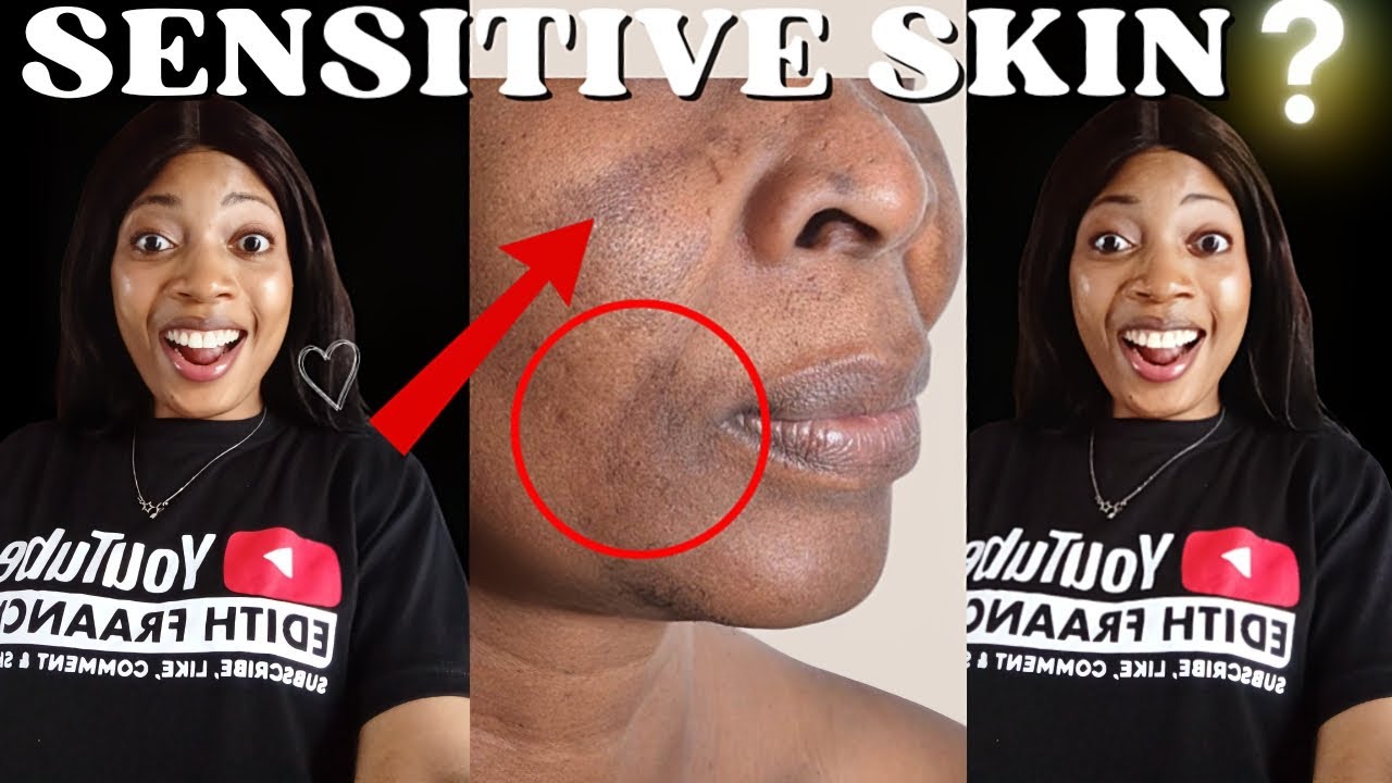 Hyperpigmentation treatment for black skin - YouTube