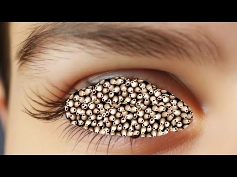 ASMR Treatment Eye Remove Infection Maggot & Ticks | Severely loosing ...