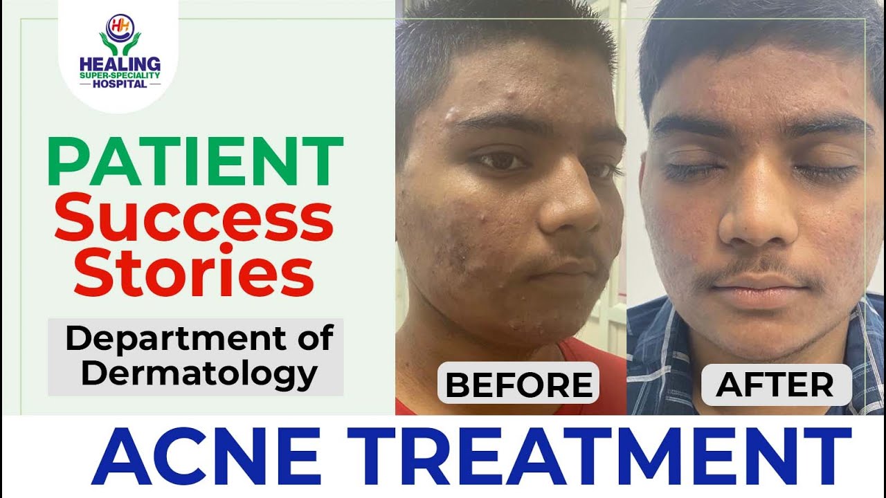 Acne Treatment | Pimples Removal | Patient Feedback | Dept. of ...