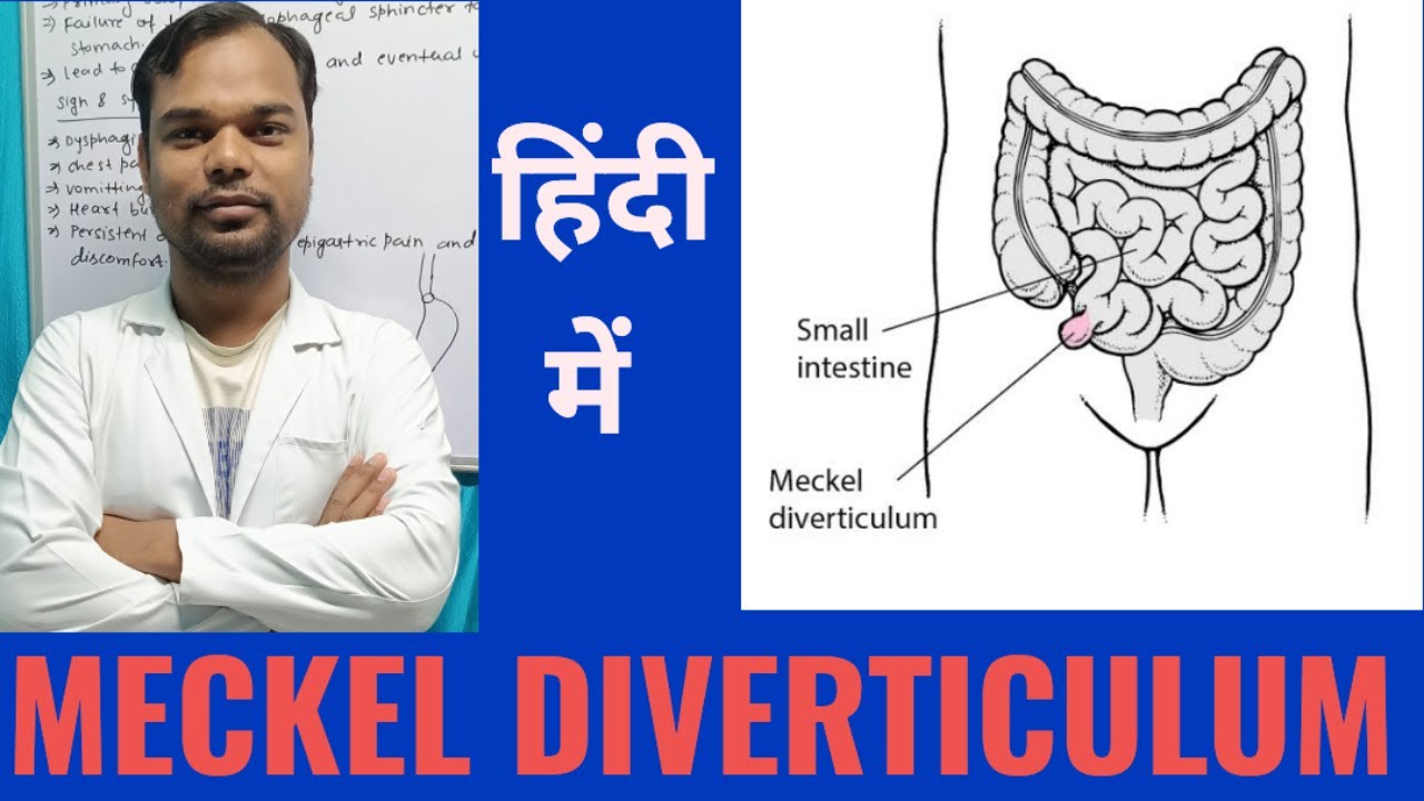 Meckel’S Diverticulum: Causes, Symptoms, And Treatment – AVKIU