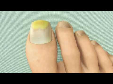 PinPointe Laser Treatment for Toenail Fungus - YouTube