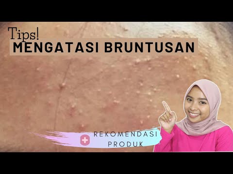 PENYEBAB BRUNTUSAN + TIPS AMPUH MENGATASI BRUNTUSAN