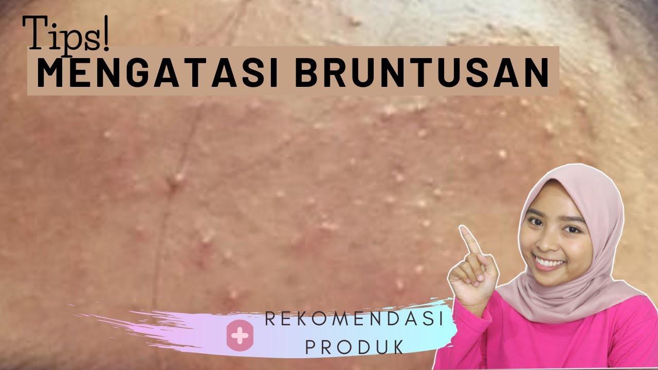 PENYEBAB BRUNTUSAN + TIPS AMPUH MENGATASI BRUNTUSAN - YouTube