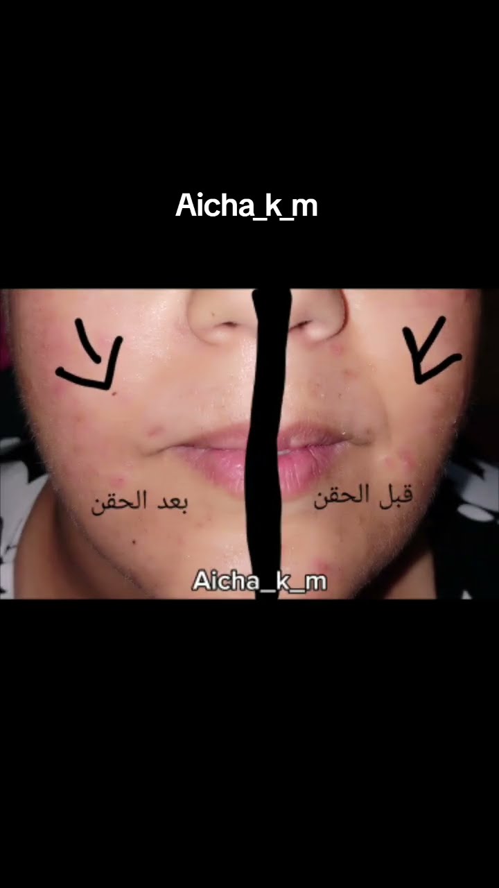 ازالة خطوط الضحك ورفع الخدود بحقن مواد طبيعية نتيجة اول من الثواني الحالة في تحسن مستمر Aichak