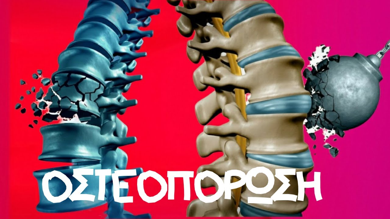 ΠΩΣ ΘΑ ΑΝΤΙΜΕΤΩΠΙΣΕΙΣ ΤΗΝ ΟΣΤΕΟΠΟΡΩΣΗ... 5 ΠΡΑΓΜΑΤΑ ΠΟΥ ΕΠΗΡΕΑΖΟΥΝ. # ...