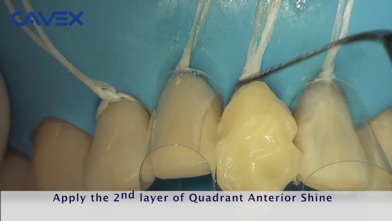 Quadrant Anterior Shine Restoration by Stephane Browet (EN) - YouTube