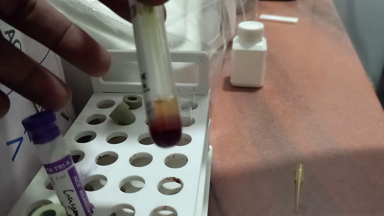 BLOOD SUGAR TEST,BSF&BSPP ,agb 2020 - YouTube