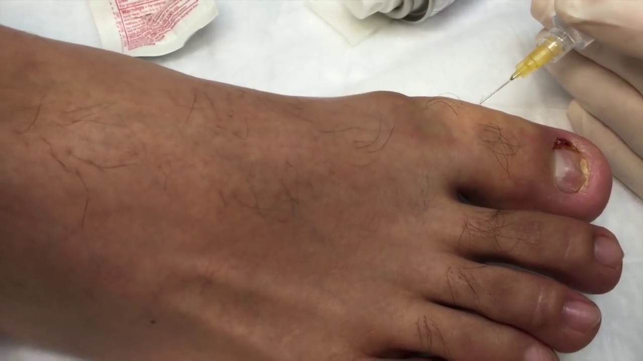 Patient's Ingrown Toenail Returns, Better Get the Matrix for Him! - YouTube