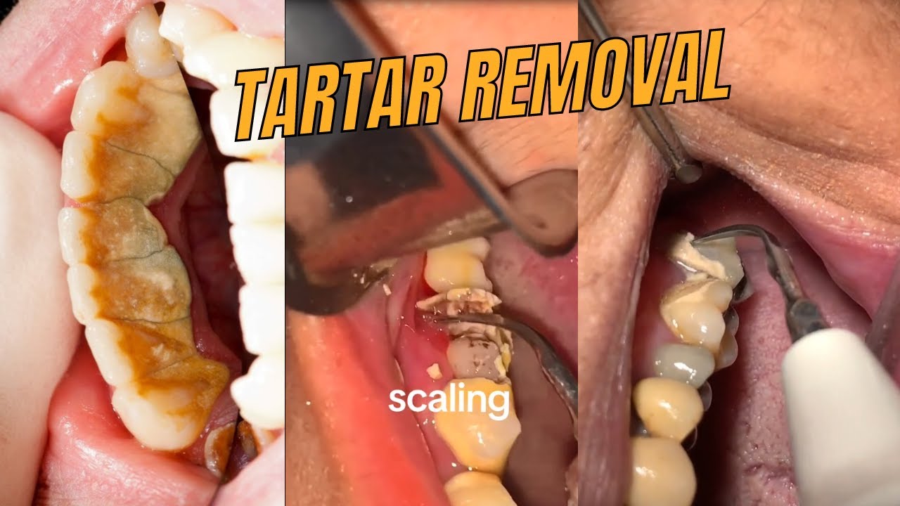 Teeth cleaning / Tartar removal / Scaling | Dental calculus. - YouTube