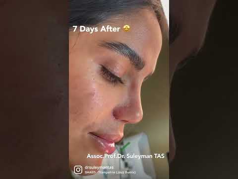 7 Days After Rhinoplasty | Dr. TAS