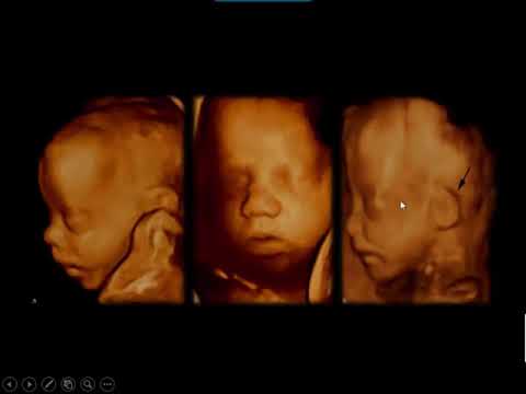 Obstetric U/S (10): Fetal Anatomy Scan - YouTube