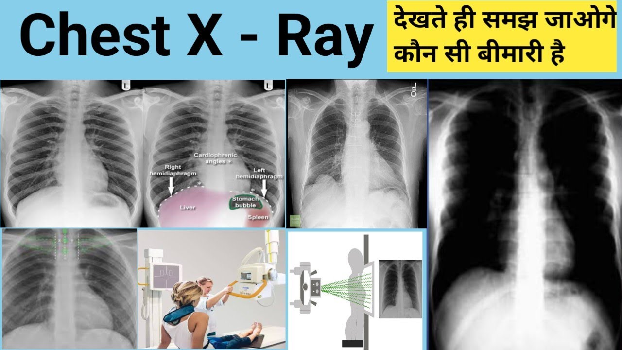 Chest X Ray | X Ray | X Ray Reading | Pneumonia | Lungs Effusion | X ...