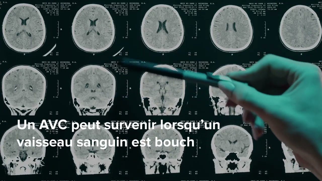 L'AVC chez les Personnes Âgées en Bref - YouTube